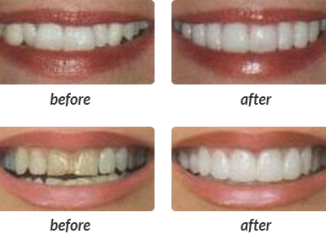 And Before Caps Teeth After