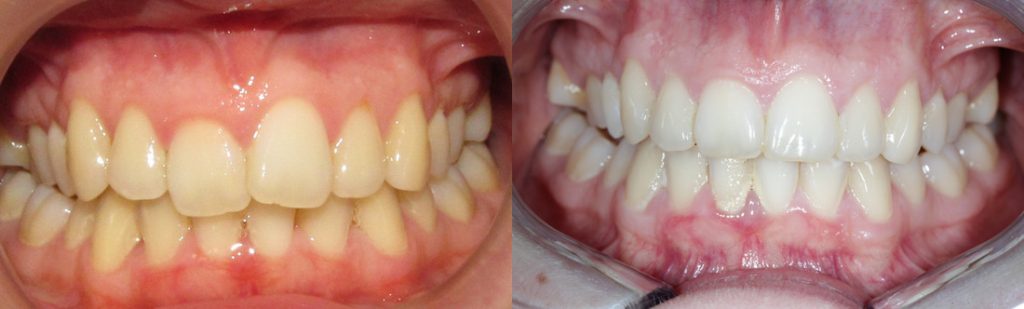 Teeth Reshaping Before And After - Dental News Network
