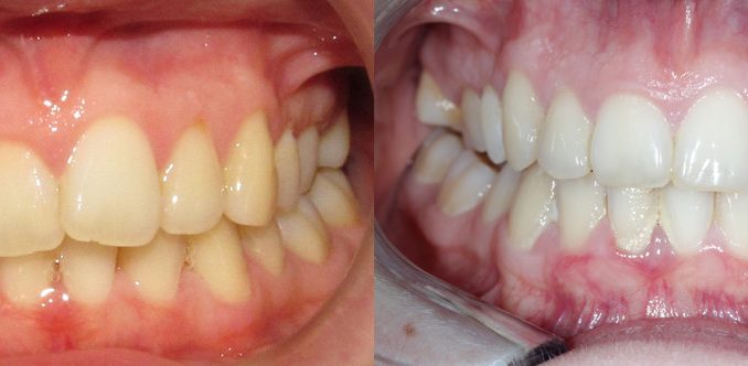 Teeth After And Before Reshaping