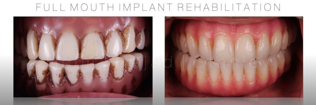 Titanium Tooth - Dental News Network