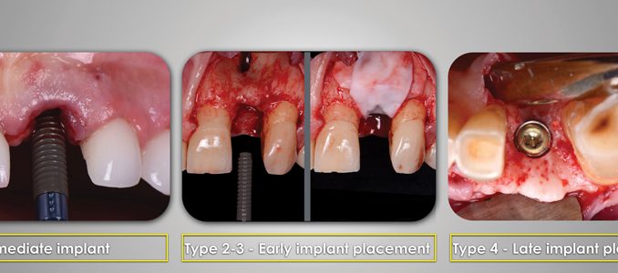 Implant Extraction And Tooth