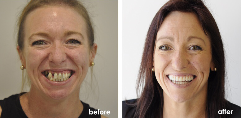 Bad Teeth Pictures Before And After Dental News Network Bad Teeth Pictures Before And After Dental News Network