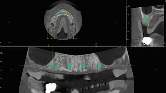 Can you have an mri with dental implants - Dental News Network