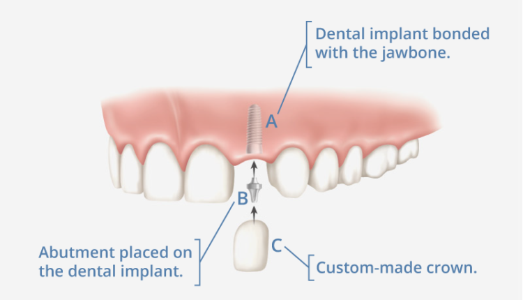How do dental implants work - Dental News Network