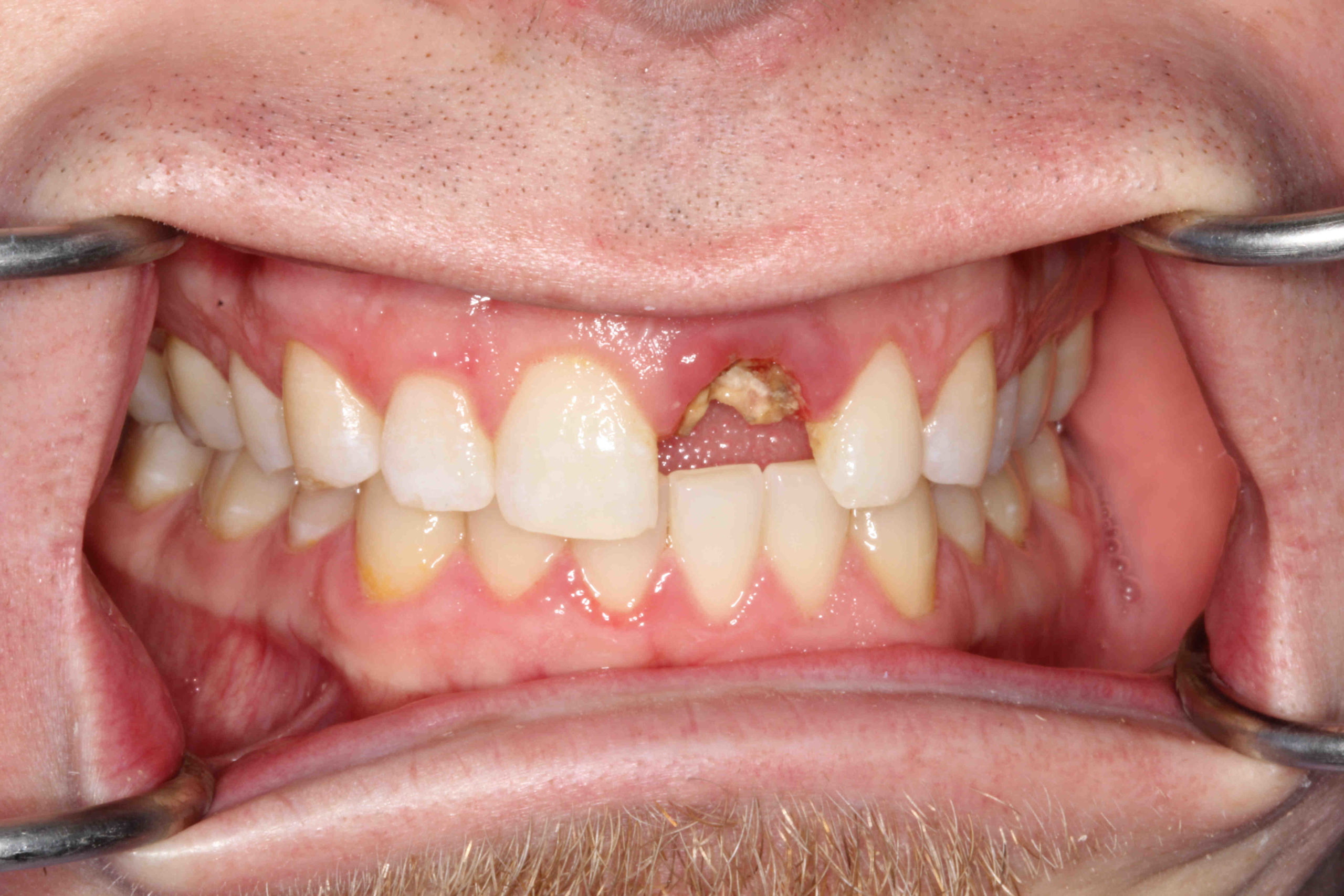 How Long Do Dental Implants Last Dental News Network