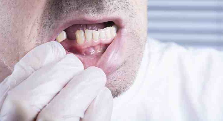Can Dental Implants Change Shape Of Face Dental News Network can-dental-implants-change-shape-of-face-dental-news-network