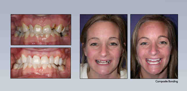 Cosmetic dentistry dental bonding - Dental News Network