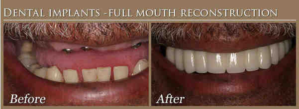 How much does a full mouth dental implant cost - Dental News Network