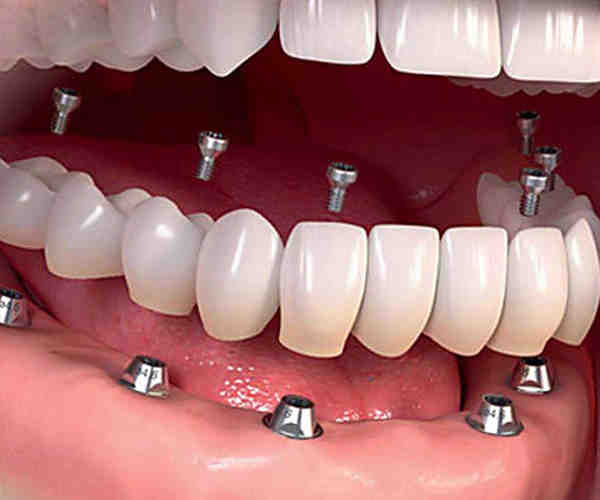 How much are a full set of dental implants - Dental News Network