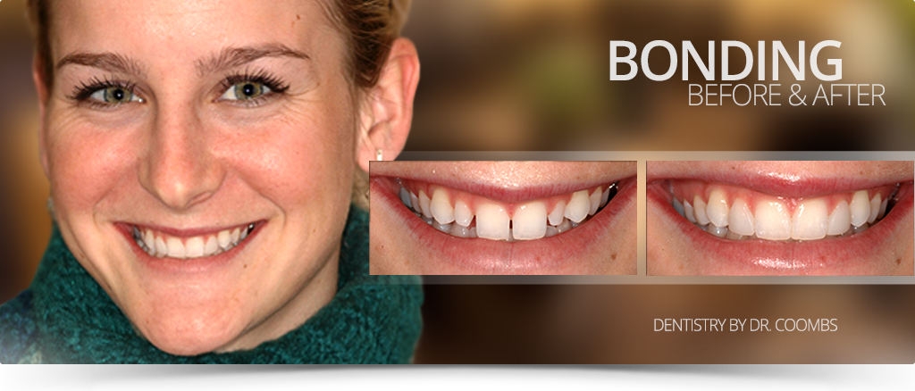 Cosmetic dentistry dental bonding - Dental News Network