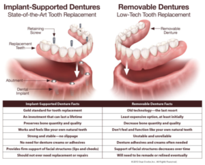 Does denti cal cover dental implants - Dental News Network