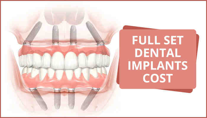 How much are a full set of dental implants - Dental News Network