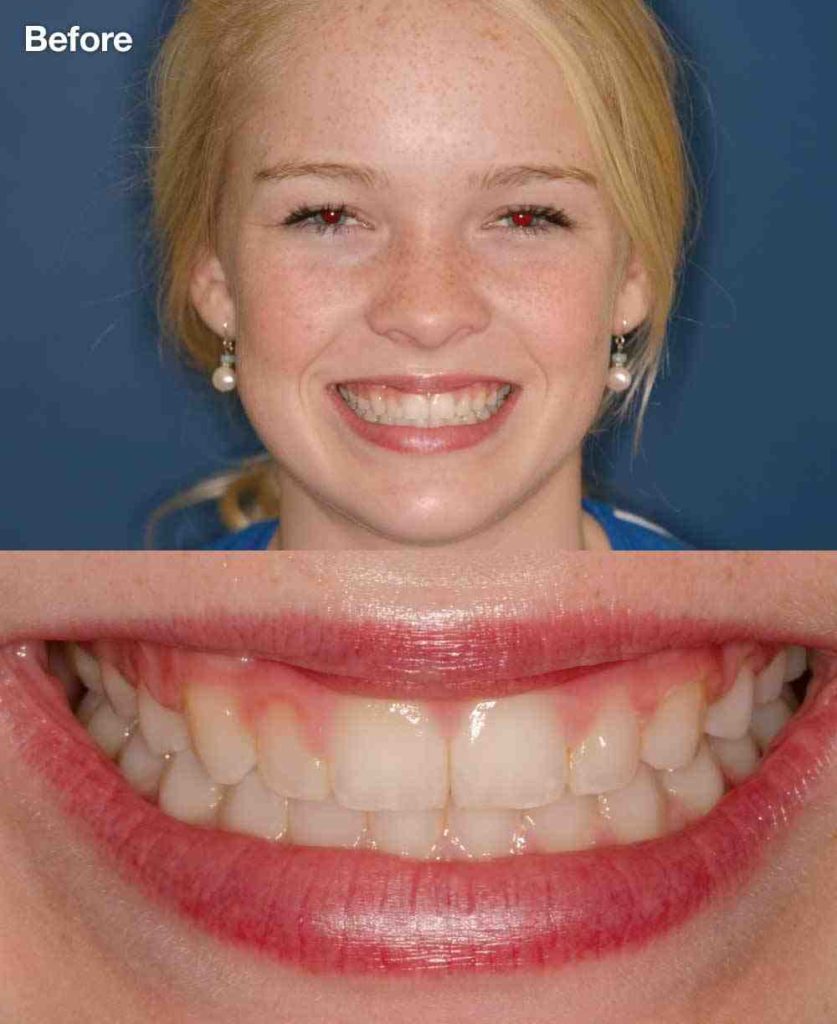 Cosmetic dentistry big front teeth - Dental News Network
