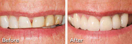 Cosmetic dentistry for ground teeth - Dental News Network