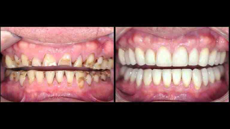 Cosmetic dentistry for ground teeth - Dental News Network