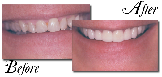 Cosmetic dentistry front teeth fillings - Dental News Network