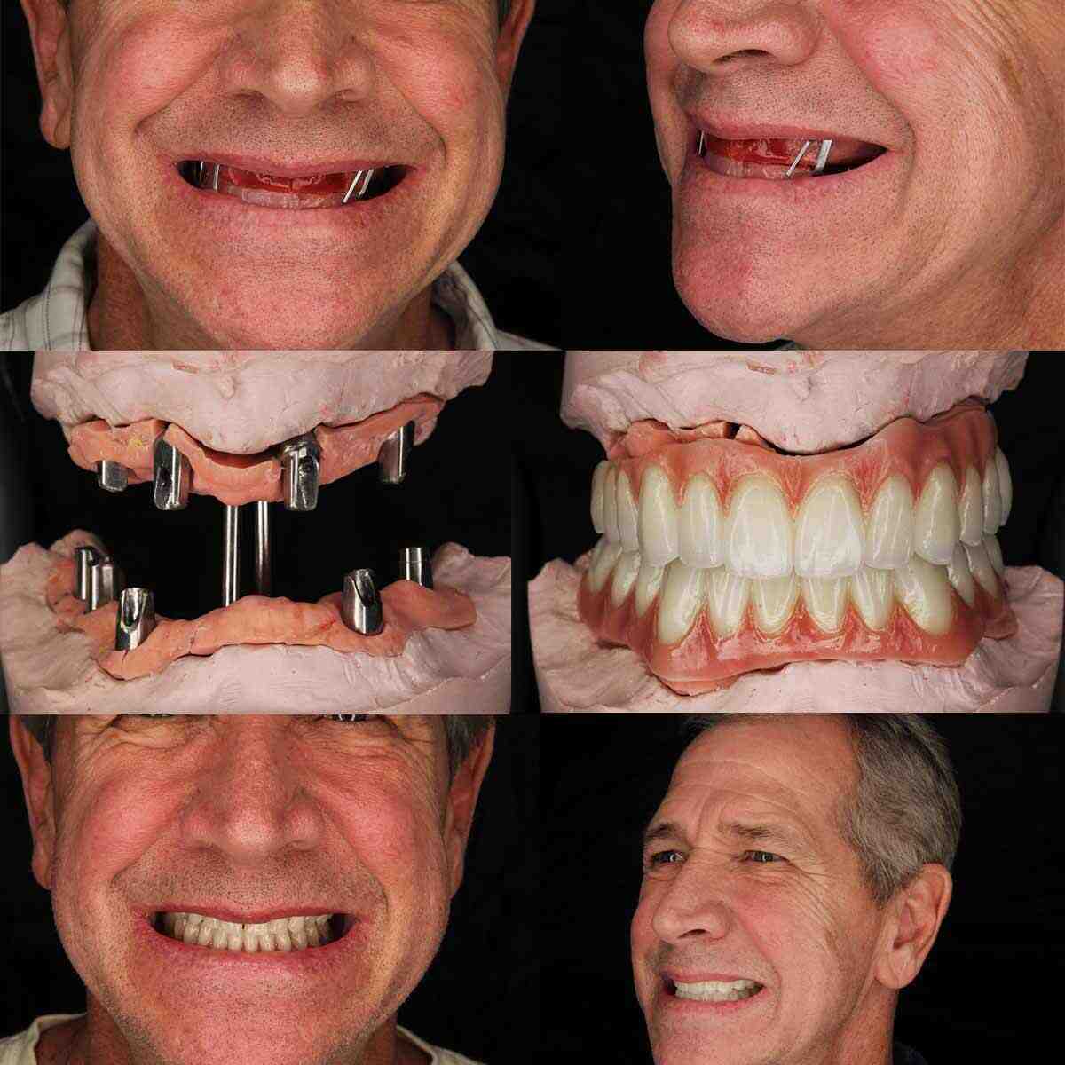What is the cost of full mouth dental implants - Dental News Network