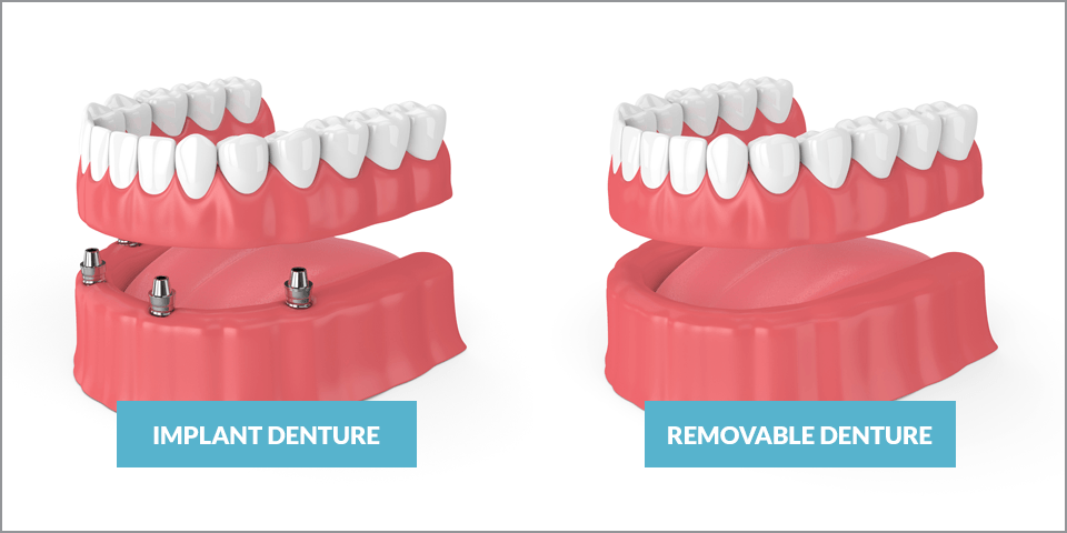 What is the cost of dental implants for the back top two teeth - Dental ...