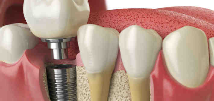 What is a mini implant for dental - Dental News Network