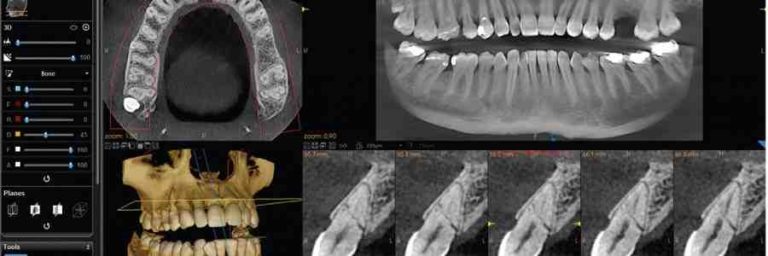 How to read cbct for dental implants - Dental News Network