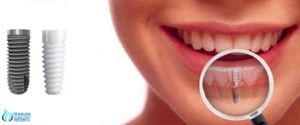 What are the side effects of dental implants - Dental News Network