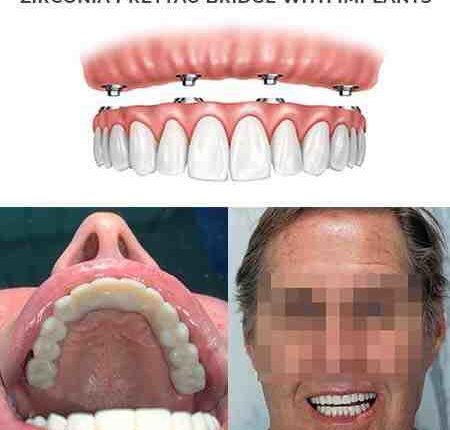 How much do full plate dental implants cost - Dental News Network