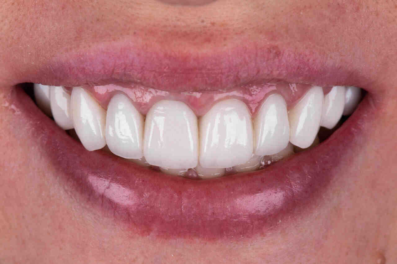 How Much Does Dental Implants Usually Cost Dental News Network