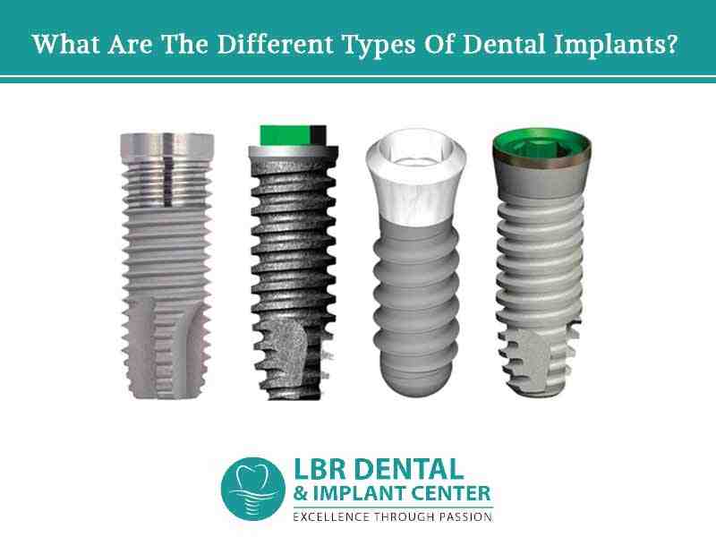 Are there different types of dental implants - Dental News Network