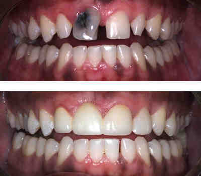 Cosmetic dentistry to restore smile - Dental News Network