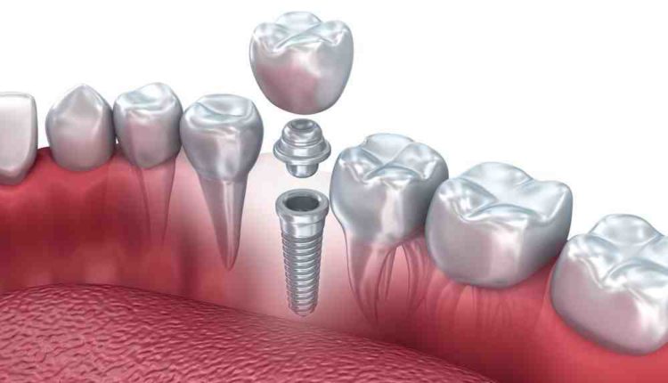 What are the side effects of a dental implant - Dental News Network