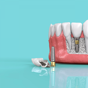 Is there a dental plan that covers implants - Dental News Network