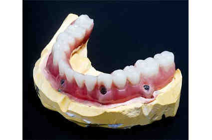 What is hybrid dental implants - Dental News Network