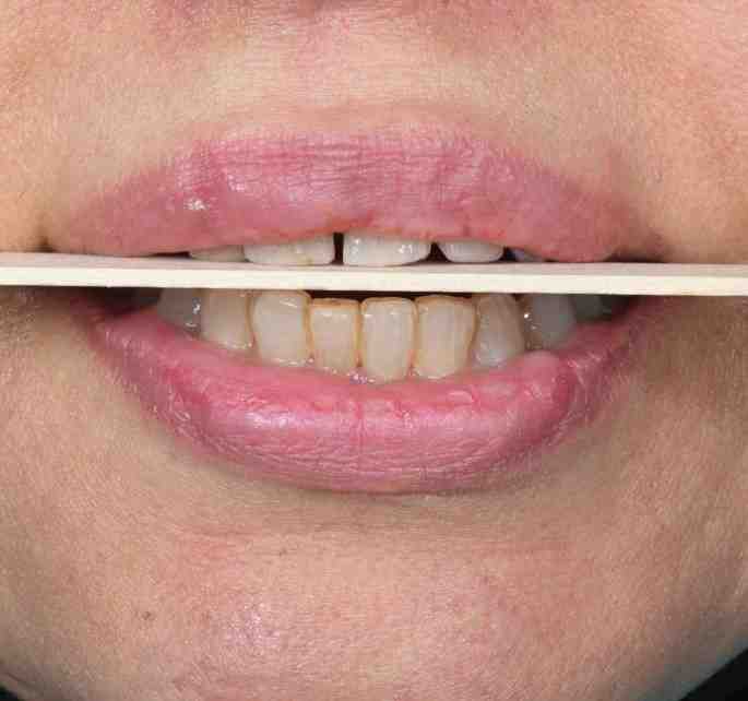 Cosmetic dentistry relaxed lip line - Dental News Network