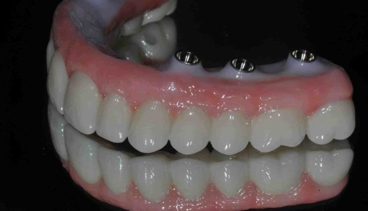 What metal is used in dental implants - Dental News Network