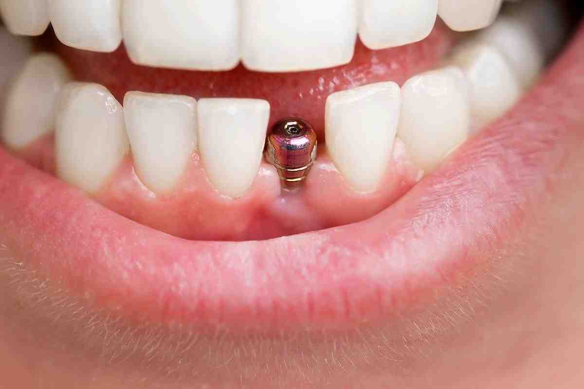 What is the dental procedure for implants - Dental News Network
