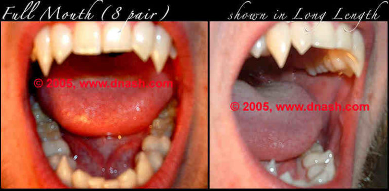 Cosmetic dentistry werewolf fanhs - Dental News Network