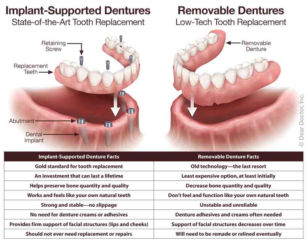 What Does It Feel Like To Have Dental Implants Dental News Network