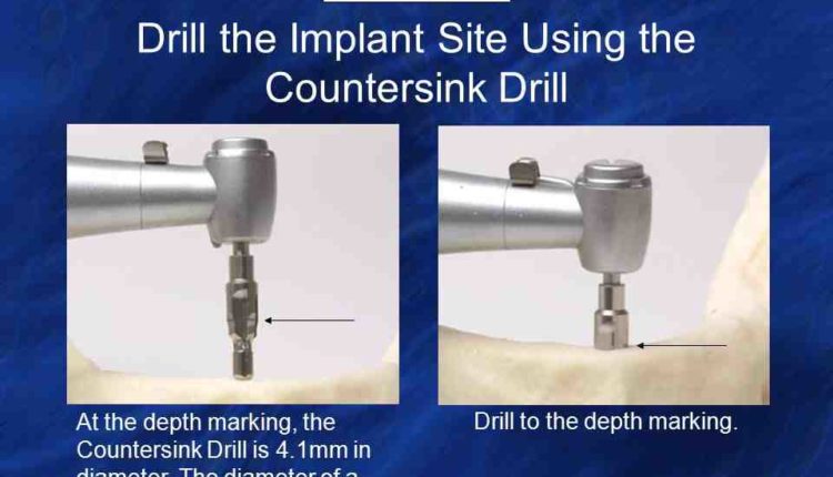 What is countersinking in dental implants - Dental News Network