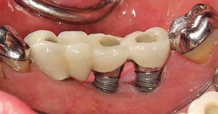 How do you know when there is a problem with a dental implant - Dental ...