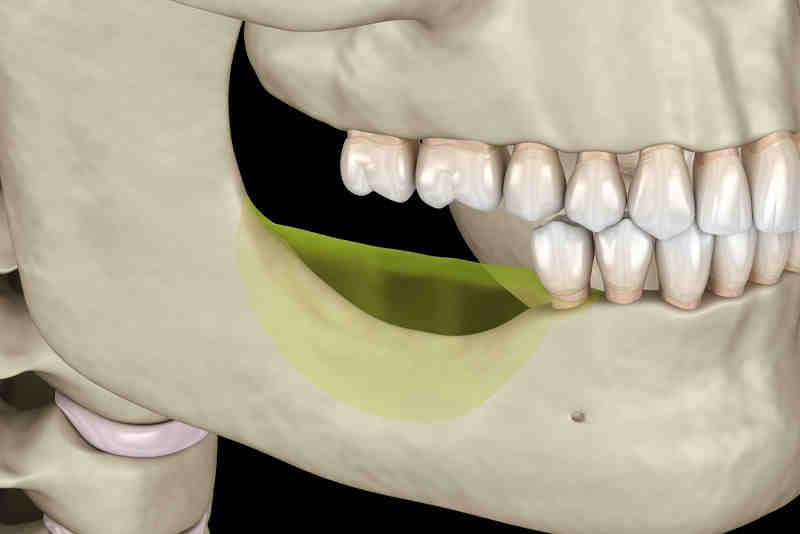 How Much Does It Cost For Bone Grafting For Dental Implants Dental 