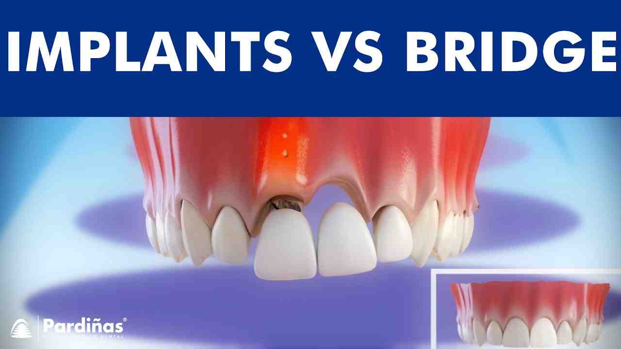 Is dental denches better than implants - Dental News Network