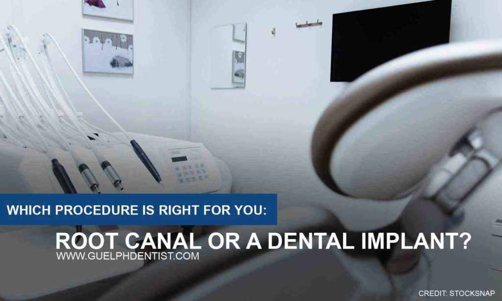 Are dental implants cheaper than root canals - Dental News Network