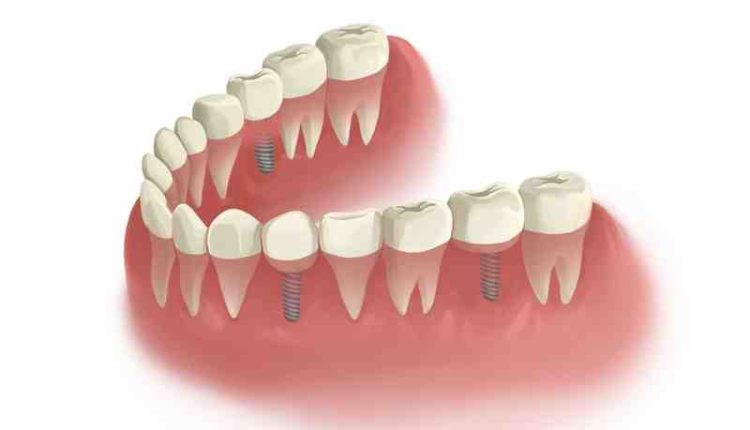 How much does a bone graff cost prior to dental implant - Dental News ...