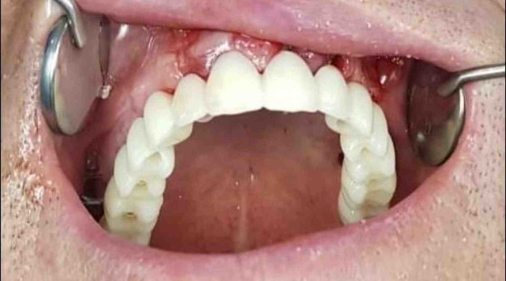 How much does a bone graff cost prior to dental implant - Dental News ...