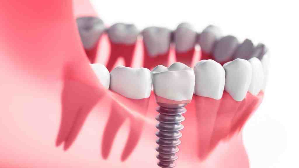 Can dental implants reverse face colapse - Dental News Network
