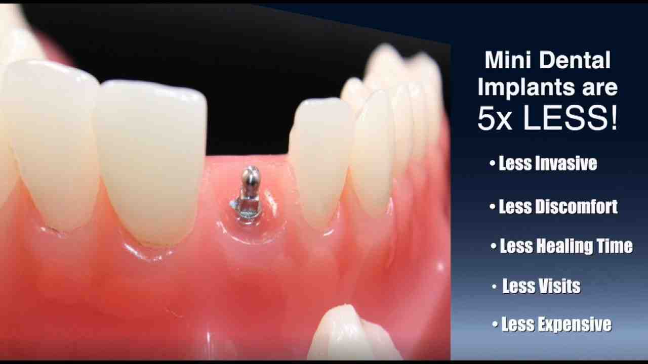 How much of the upper palate can be removed with mini dental implants ...