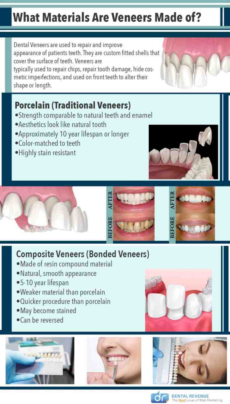 Do your teeth rot under veneers? - Dental News Network