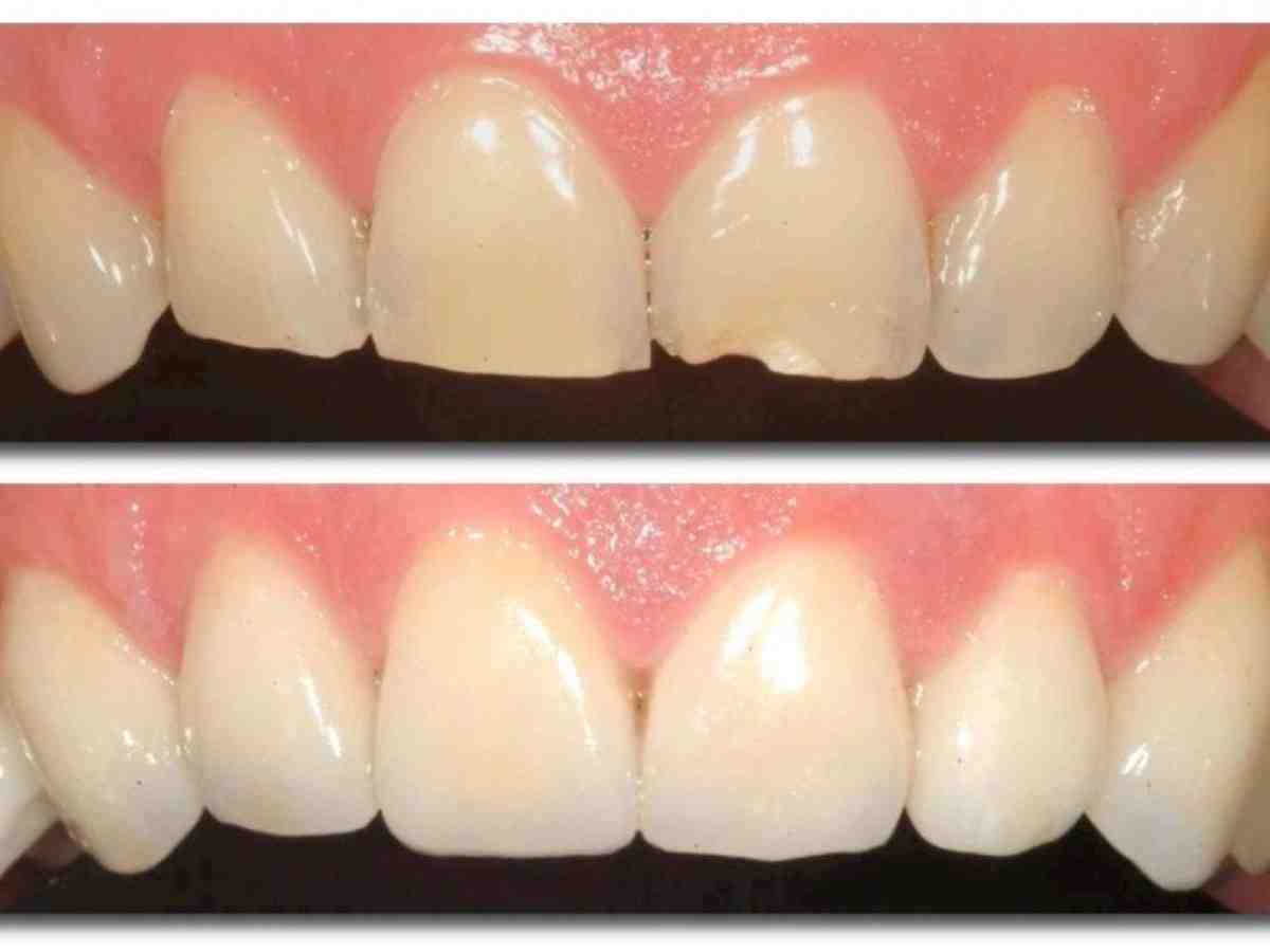 Do veneers decay teeth? - Dental News Network