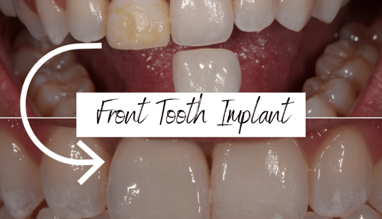 Do Dental Implants Look Like Real Teeth Dental News Network