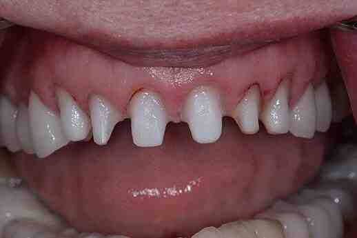 Do veneers last a lifetime? - Dental News Network